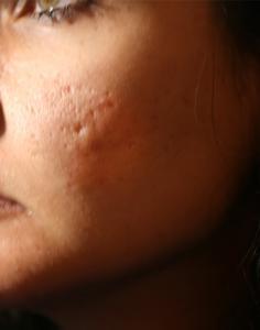 Acne Treatment | SkinDoc - Acne Treatment | Liverpool, NSW